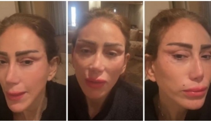 Témoignage poignant : Reham Saeed dévoile son visage défiguré après une ...