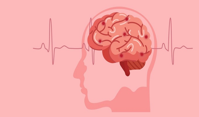 AVC : un test sanguin révolutionnaire pour un diagnostic précoce et ...